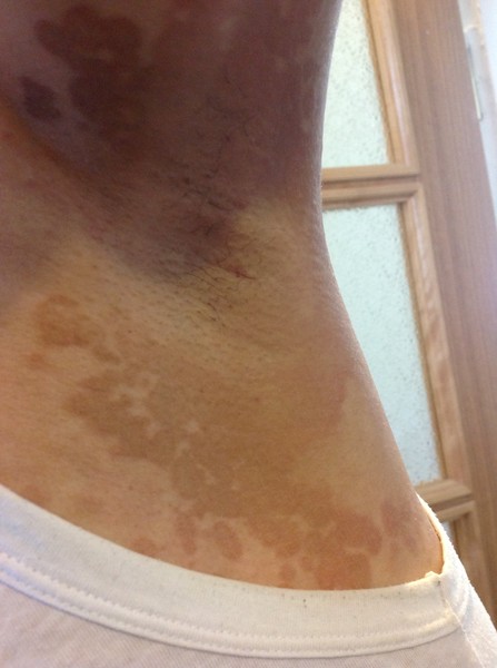 Ответы Mail.ru: Кто знает чем лечить такое? Появились темные пятна под ...